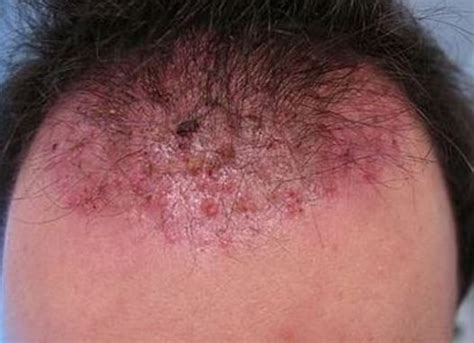 Ingrown Hair Bump On Head