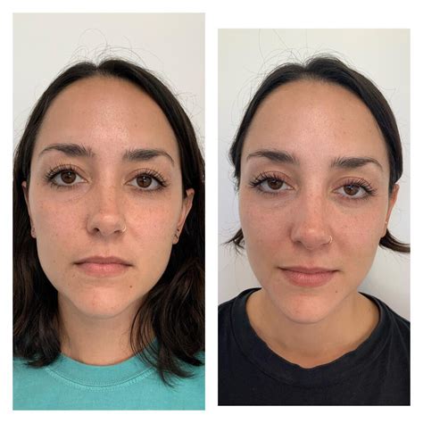 Botox Before And After In Oakland Ca Dr Vasanwala