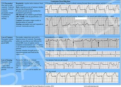 Cardiac Arrhythmia Reference Chart Pdf Cardiovascular Nursing Education Associates Cardiac Arrhythmia Reference Chart Pdf Cardiovascular Nursing Education Associates