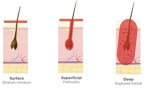 Folliculitis And Pyoderma Flashcards Quizlet