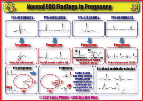 Ecg Educator Blog Ecg Parameters In Pregnancy