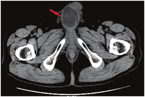 Ct Scan Of A Mass Of 49 × 35 Cm Found In The Cavernous Body Of The