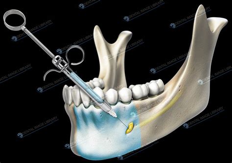 Dental Anesthesia Nerve Block At Terry Haskell Blog
