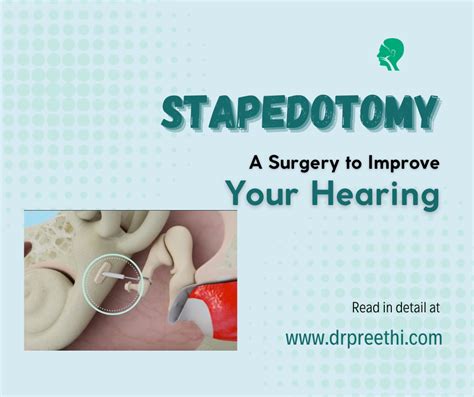 Stapedectomy A Tiny Surgery A Big Impact Dr Preethi Umamaheswaran