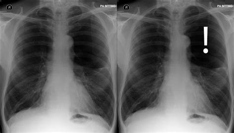 Incidental Spontaneous Pneumothorax In A Patient With 43 Off
