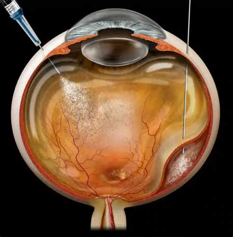 Retinal Injections Intravitreal Injection Mumbai Eye Retina Clinic India