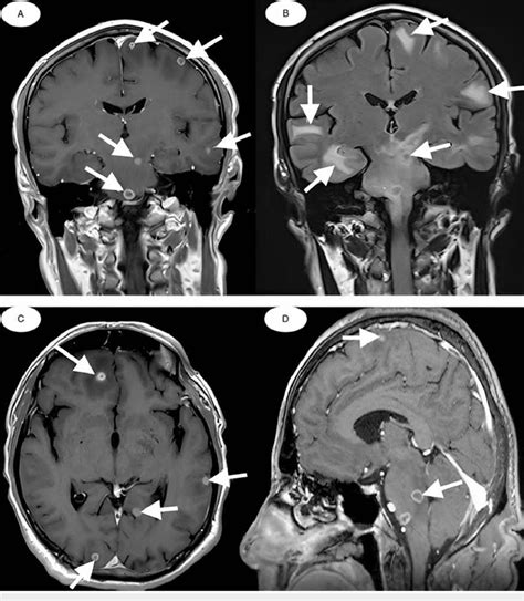 Brain Ct Scans In Different Planes Coronal Axial And Sagittal