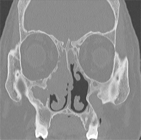 Computed Tomography Ct Scan Ct Findings Of A Patient With Cf Crs
