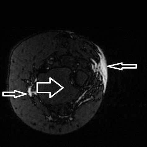 A Female With Lipo Lymphedema Stage Ii Conservative Management Manual
