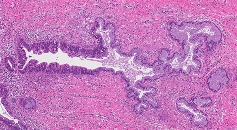 Cervix Ottawa Atlas Of Pathology