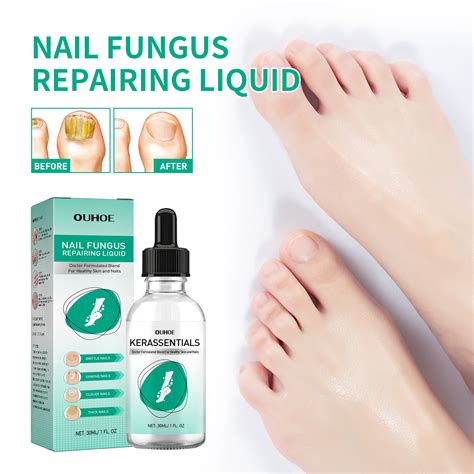 Ouhoe Toenail Repair Solution For Thickened Yellowing Brittle Nails