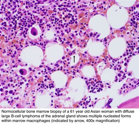 Pathology Outlines Hemophagocytic Lymphohistiocytosis