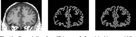 Figure 10 From Segmentation And Measurement Of The Cortex From 3 D Mr Images Using Coupled