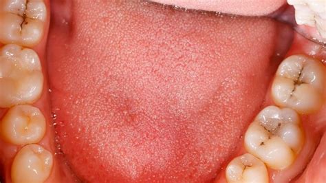 Cavities In Back Teeth