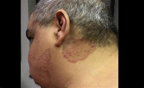 Derm Dx Asymptomatic Genital Rash Dermatology Advisor