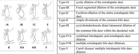 Modified Todani Et Al Classification Of Choledochal Cyst Download