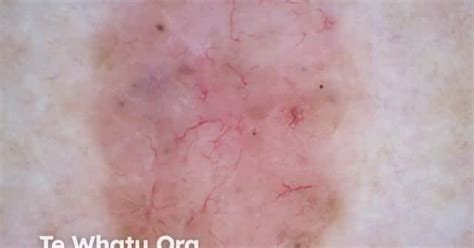 Nodular Basal Cell Carcinoma Dermoscopy Image