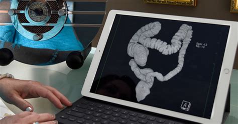 Do I Need A Colonoscopy Doctors Speak About Effectiveness After