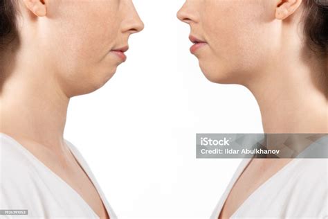 Overbite Dental Occlusion Womans Face Before And After Correction Of Malocclusion Of Teeth