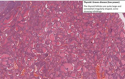 Hyperplasia Of Thyroid Gland