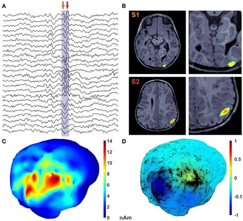 encoding of epileptic spike in diverging features a meg traces with
