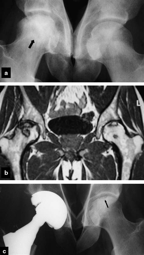 Osteonecrosis Of The Femoral Head Etiology Imaging And Treatment