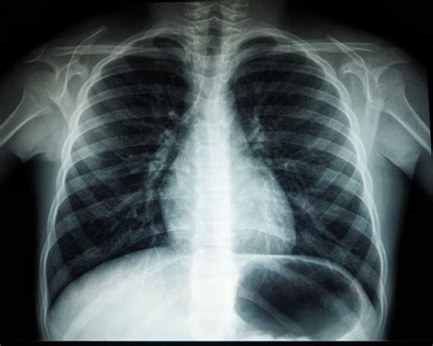 Pneumothorax Types And Definitions