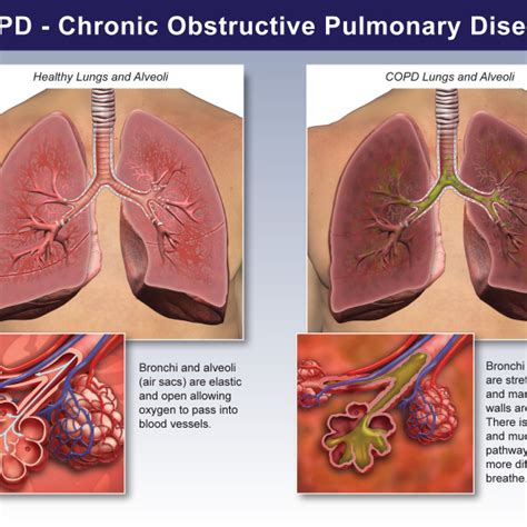 Chronic Obstructive Pulmonary Disease Trialquest Inc