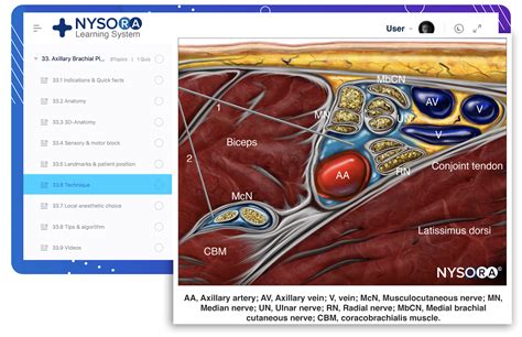 Ultrasoundguided Axillary Brachial Plexus Block