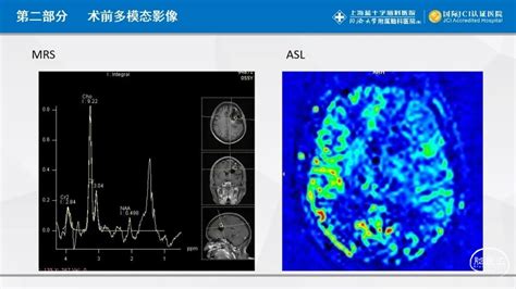【病例分享】第六届全国胶质瘤大会——胶质瘤病例分享讨论会优秀病例展示（三） 脑医汇