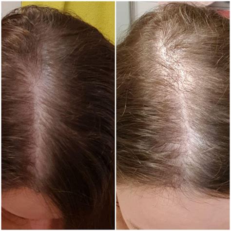 This Is What Minoxidil Did To My Hair In 3 Weeks I Am Scared And Heartbroken R Femalehairloss