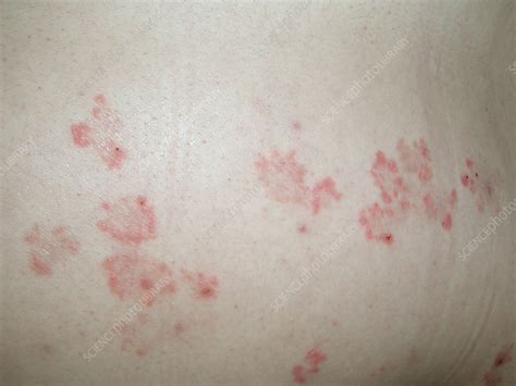 Ringworm Stock Image C056 1136 Science Photo Library