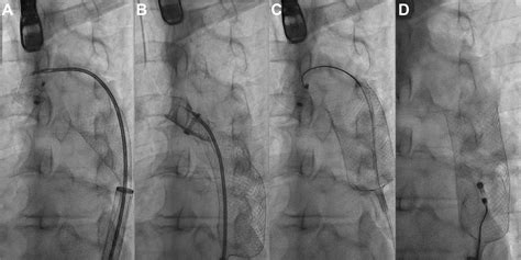 Late Hybrid Retrieval Of A Embolized Left Atrial Appendage Occlusion