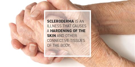 Scleroderma What You Should Know Mdsun Skin Care