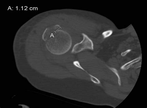 Proximal Humerus Fractures Trauma Orthobullets