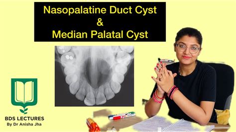 What Is A Palatal Cyst At Diana Andrzejewski Blog