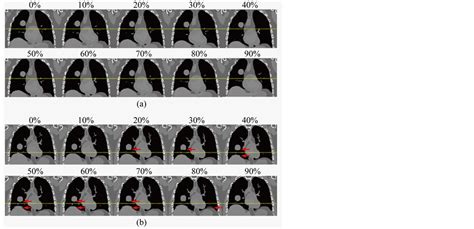 An Integrated Simulation System Based On Digital Human Phantom For 4d Radiation Therapy Of Lung