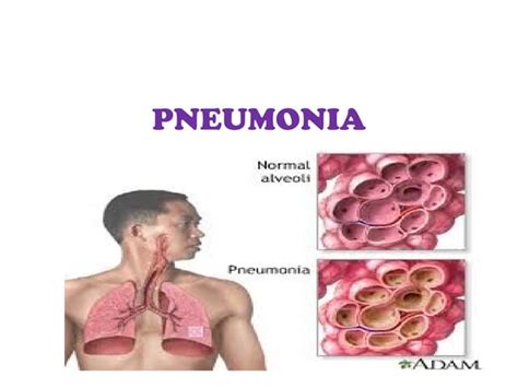 Pneumonia Pptpower Point Presentation Ppt Pptx