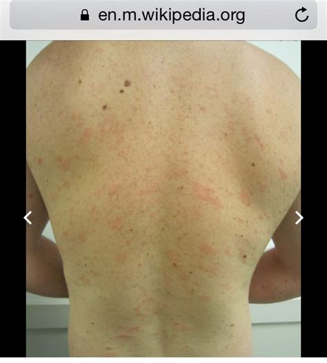 Pityriasis Rosea Christmas Tree Pattern Pityriasis Rosea Christmas Tree Pattern