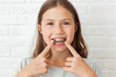 Tus Brackets Siempre Limpios Sanibook