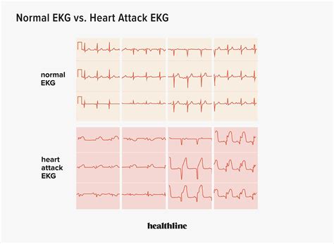 Heart Attack Ekg Can An Ekg Detect A Previous Heart Attack