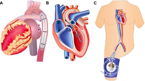 An Illustration Of Options For Mcs A Iabp B Tandemheart And C Download Scientific