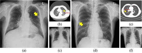 Initial And Follow Up F U Cxrs And Ct Images With A Nodule A Download Scientific Diagram