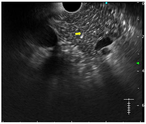 What Are Hyperechoic Strands In Pancreas