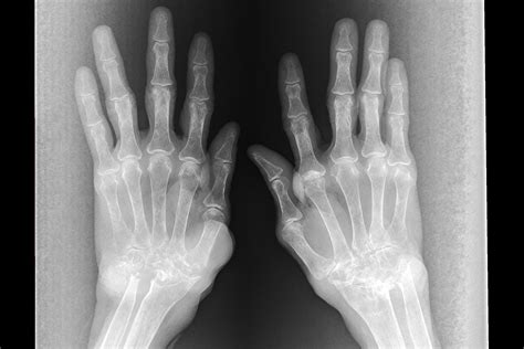 Rheumatoid Arthritis In The Wrist Symptoms Treatments And More