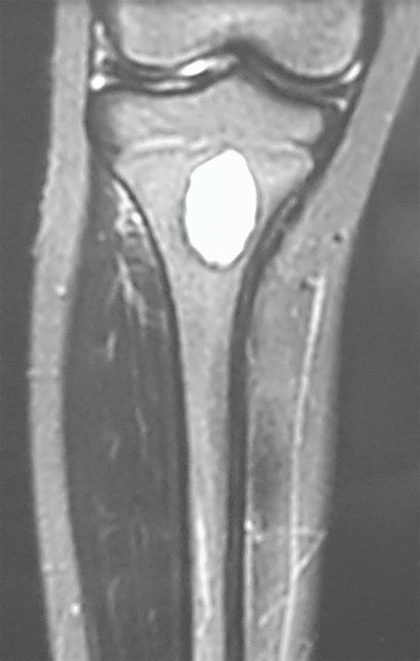 Simple Bone Cyst Of The Tibia Oncosurgery