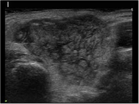 Head And Neck 43 Salivary Glands Case 432 Salivary Gland