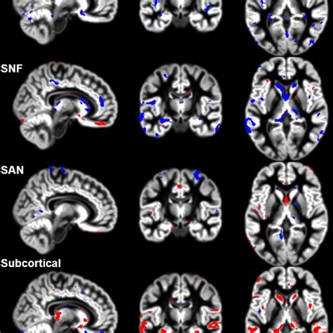 Each Subtype Shows A Unique Pattern Of Longitudinal Atrophy Compared To