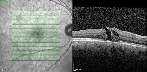 Diagnosis And Treatment For Macular Hole Klarity Health Library