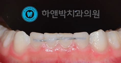 아이가 넘어져서 앞니가 흔들려요 부러진 건 아닌지 걱정돼요 치근 파절 소아 외상 잠간고정술 Wire Splint 인하대 치과 네이버 블로그